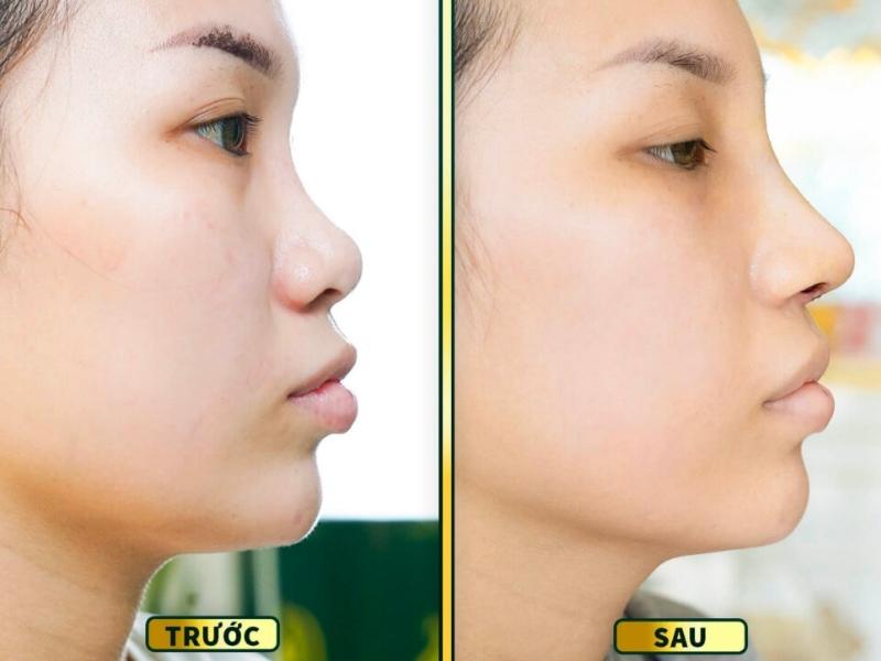 Đặc điểm của mũi là gì? Tôi có nên phẫu thuật chỉnh sửa không? - Thế ...